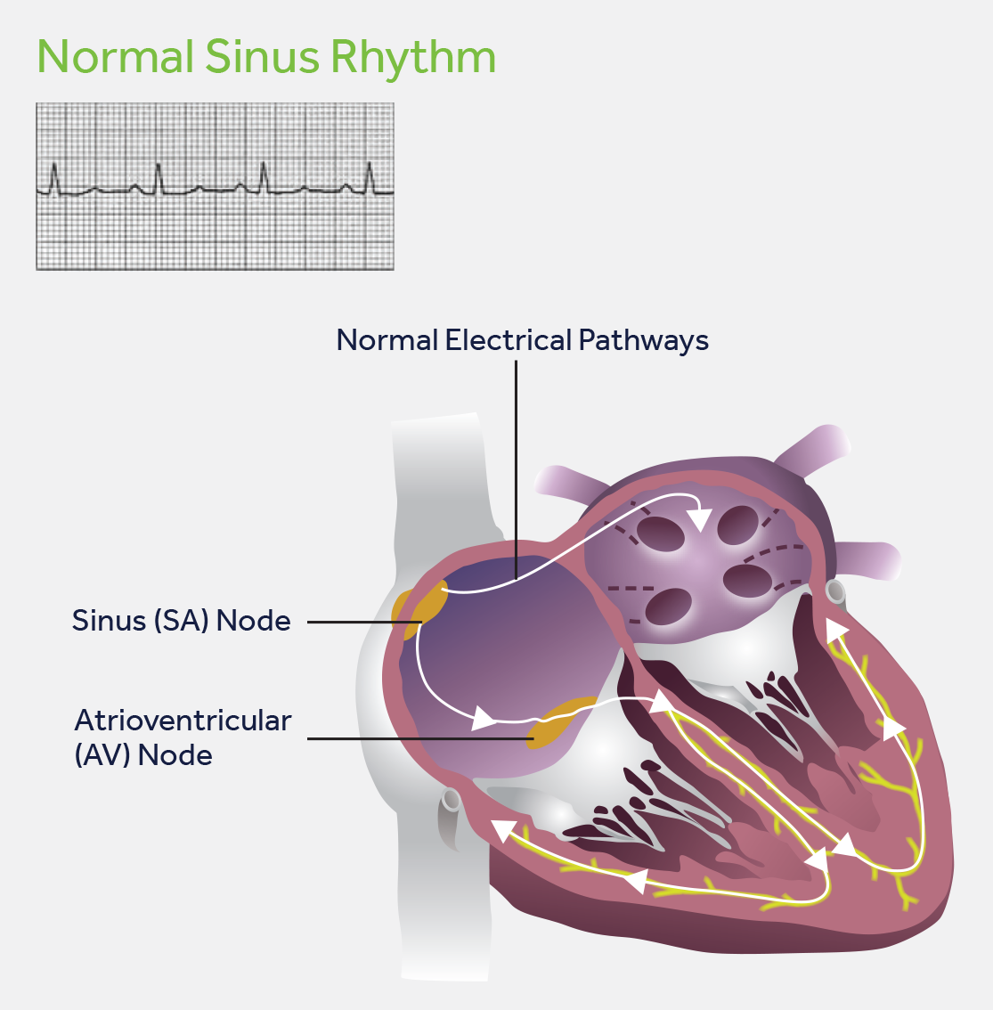 Atrial Fibrillation AFib | Richmond VA | Cardiologists | Heart Specialist