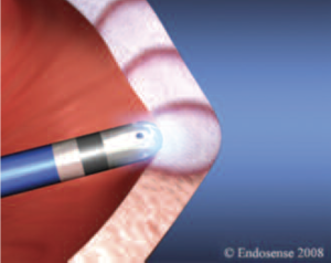 Catheter Ablation | Richmond, VA | Cardiologists | Heart Specialist