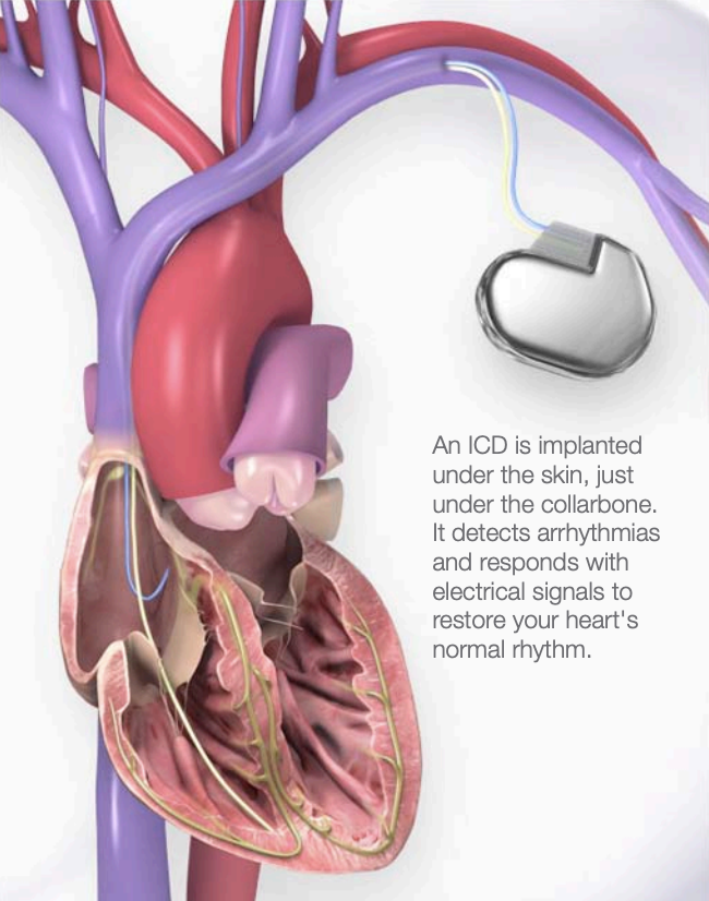 Implantable Cardioverter Defibrillator Icd Richmond Va Heart