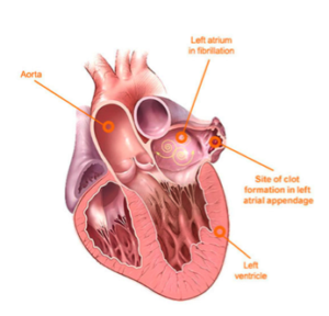 Watchman™ – Left Atrial Appendage Occlusion - Implant | Richmond VA