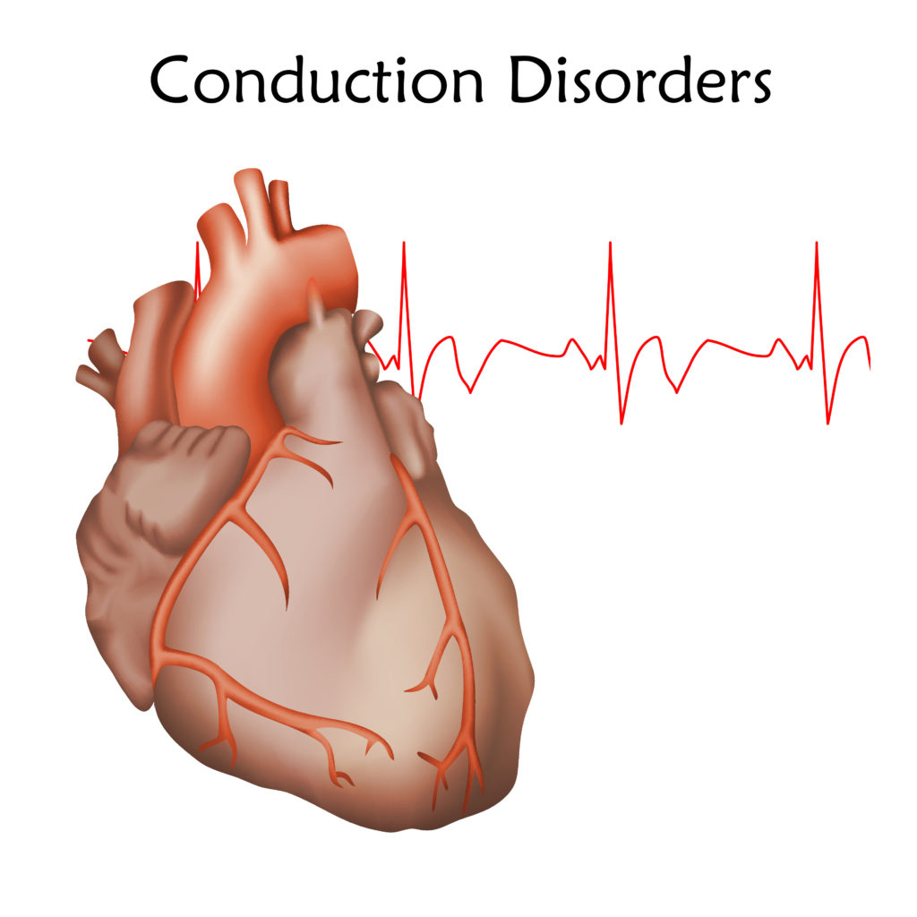 Conduction Disorders | Virginia Arrhythmia Consultants