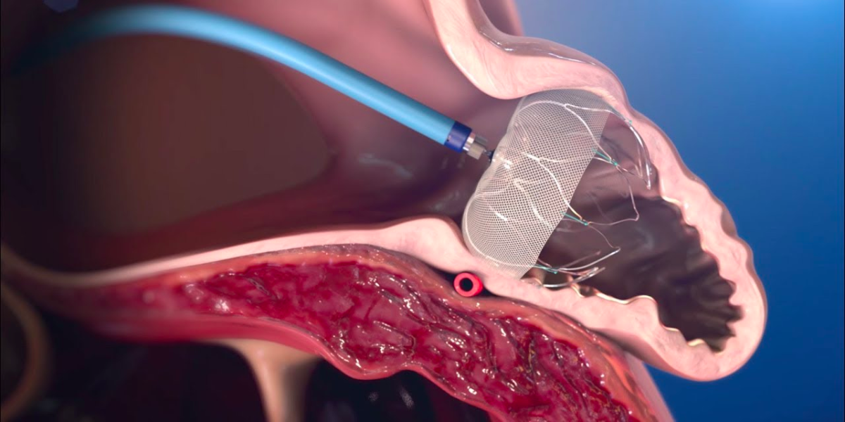 The WATCHMAN: Reducing Stroke Risk in Patients with Atrial Fibrillation ...