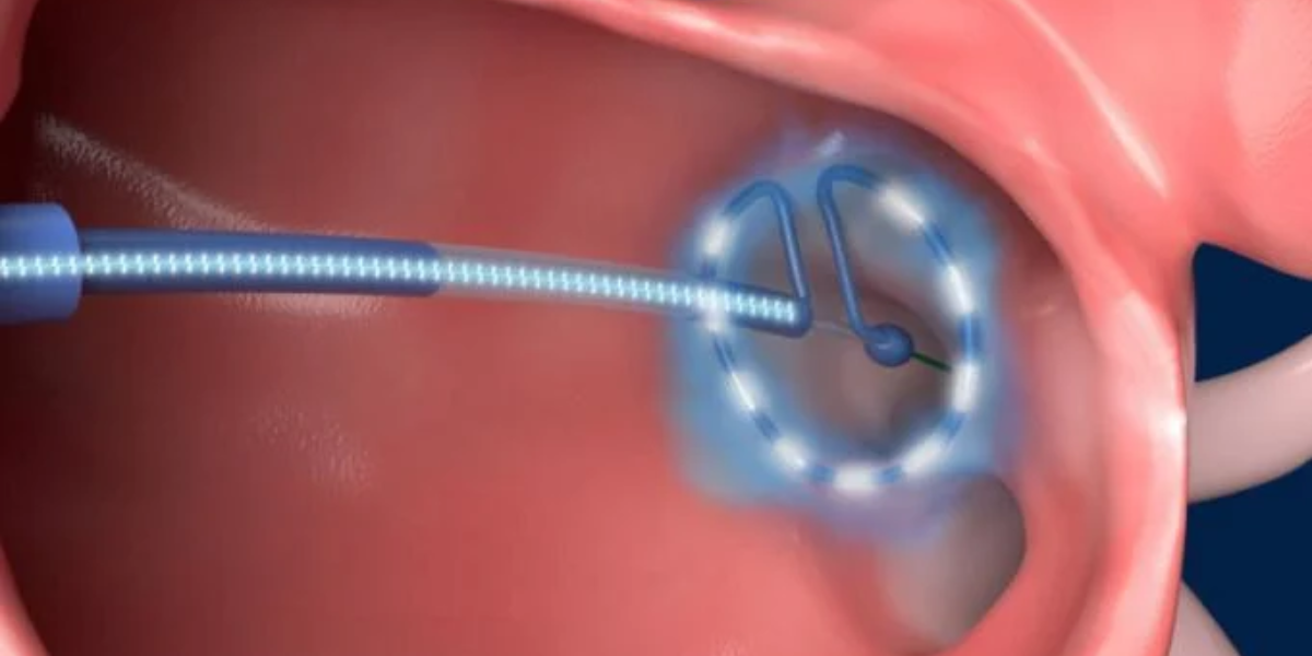 Pulse Field Ablation's Impact on Atrial Fibrillation | Virginia ...