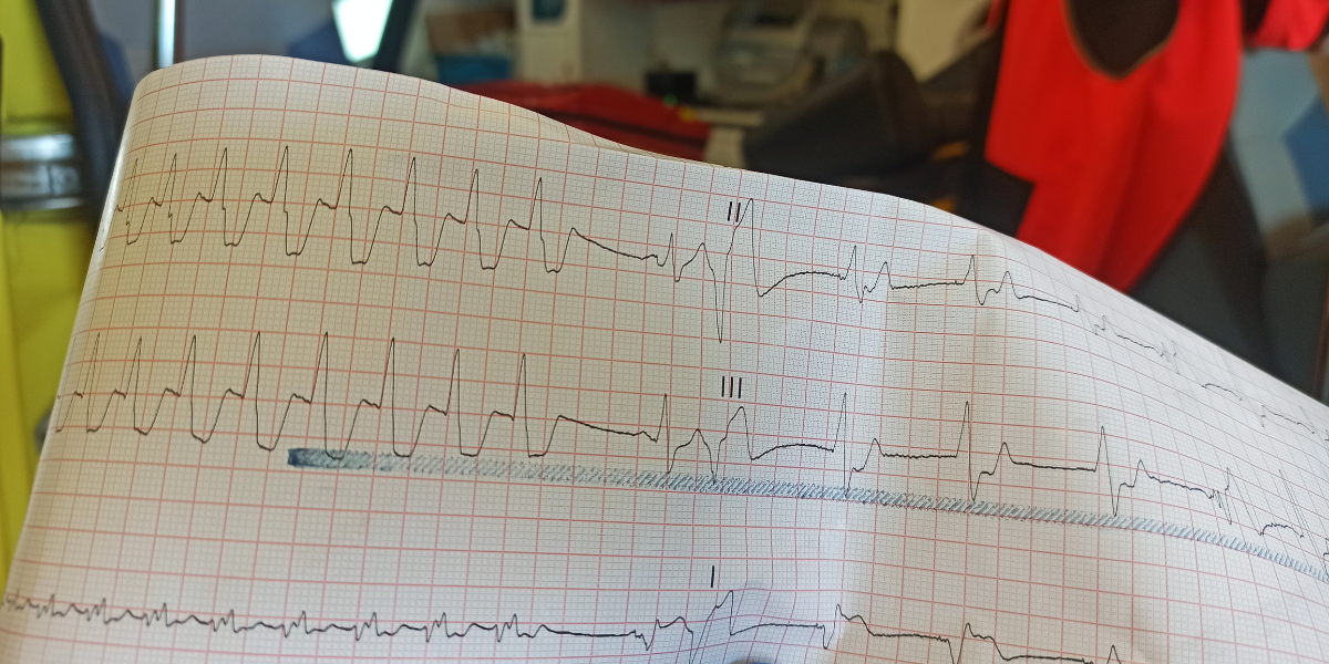 Management of Supraventricular Tachycardia | Virginia Arrhythmia ...