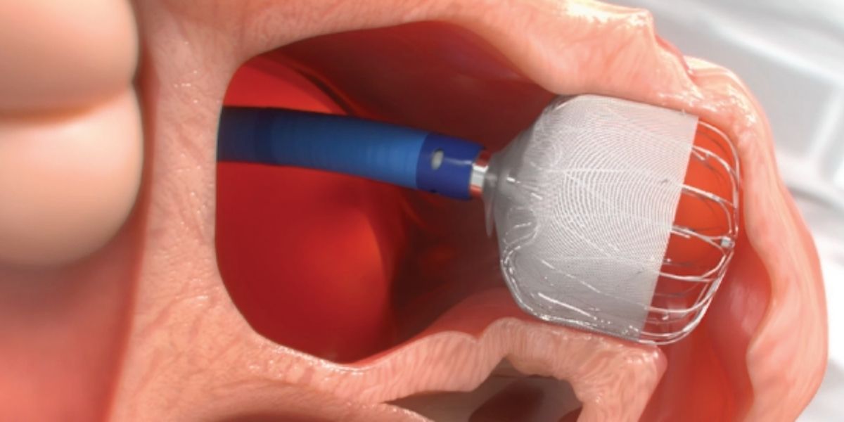 WATCHMAN Device in Richmond, VA | Virginia Arrhythmia